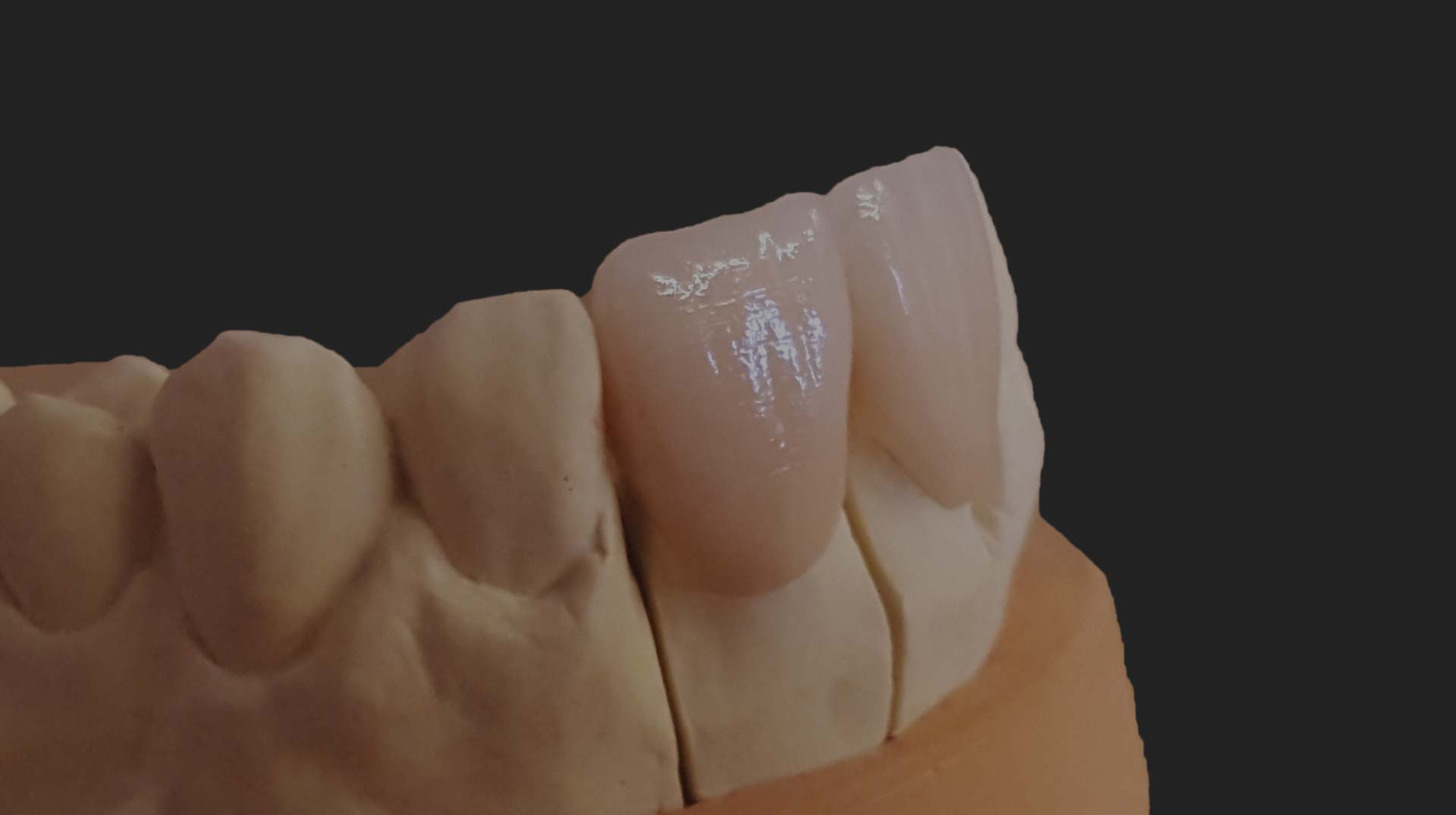 Dentallabor Krasselt Chemnitz Deckprothese Implantate